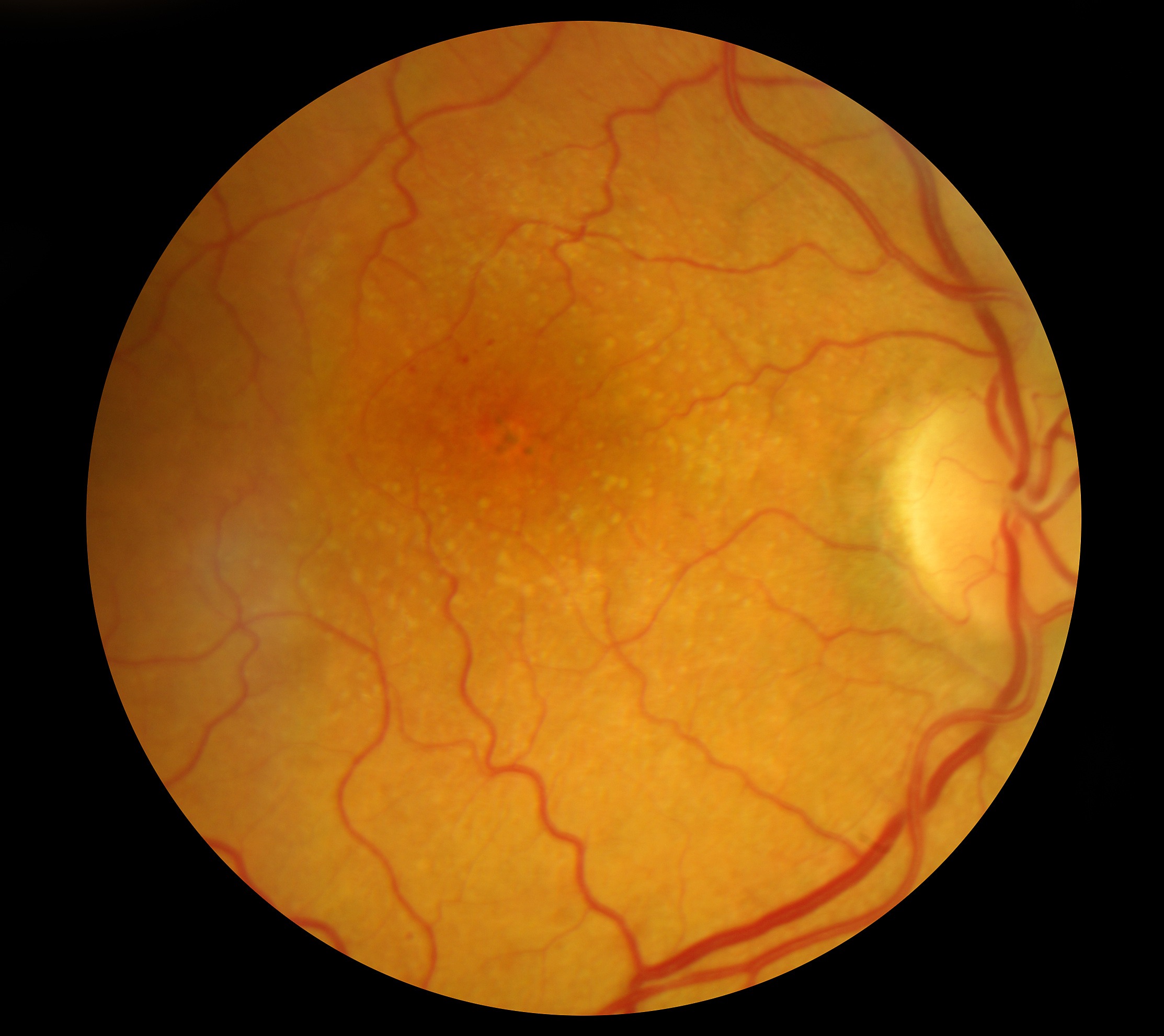 Age Related Macular Degeneration | Joseph Eye and Laser