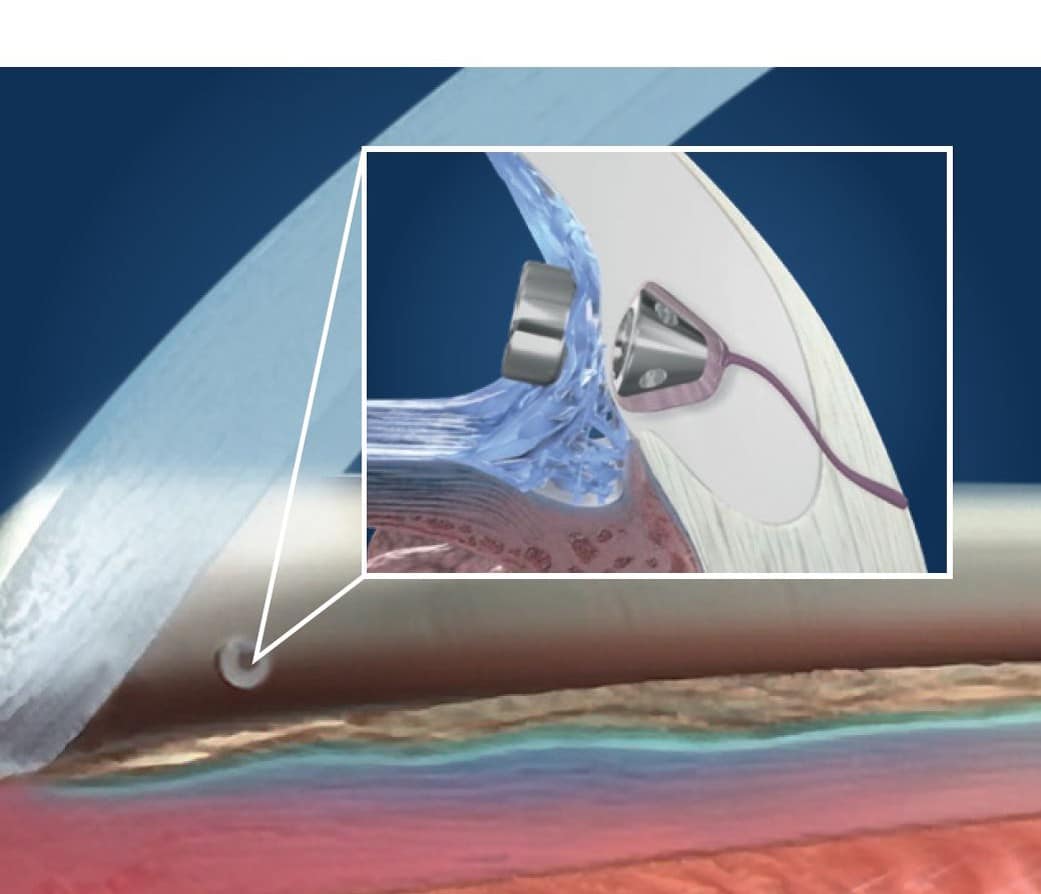 Get Off Of Your Glaucoma Drops | Joseph Eye and Laser